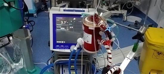 遵医附院重症医学科运用ECMO成功救治1例爆发性心肌炎患者_城市频道_新浪网