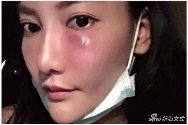 泰国美女连打6年美白针惨遭毁容!美白针究竟能不能打?美白针毁容新浪女性新浪网