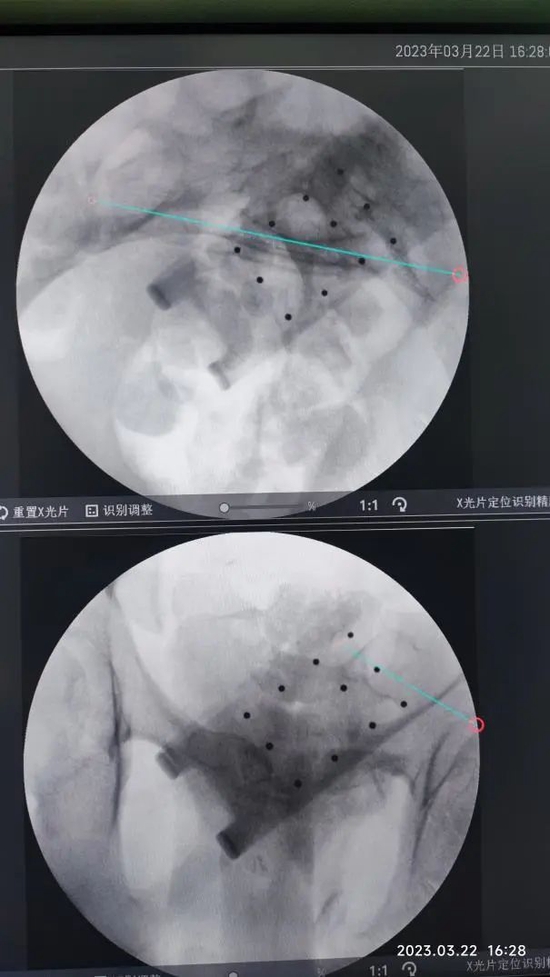 HoloSight联合UCRT技术成功完成多例高难度骨盆骨折智能可视化微创复位内固定术_手机新浪网