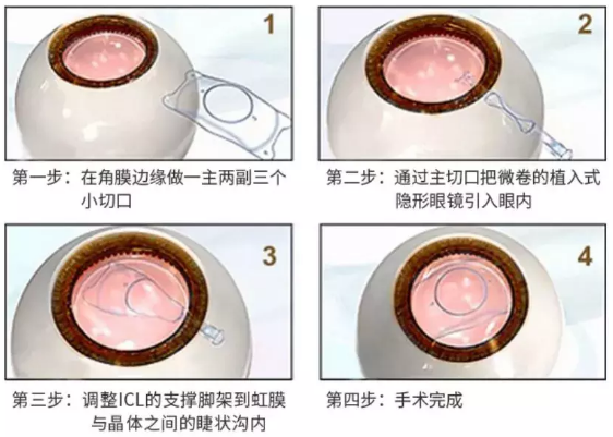 全飞秒、半飞秒、ICL、TPRK...教你分清近视手术区别