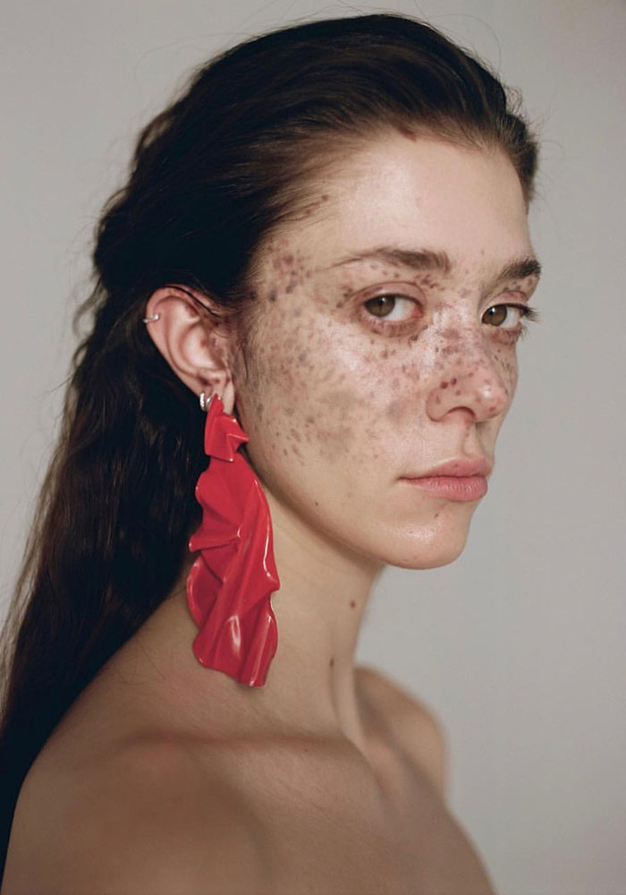 她20岁因病脸上留下大片雀斑，3年后被挖掘震撼时尚圈！|雀斑|模特儿|时尚圈_新浪新闻