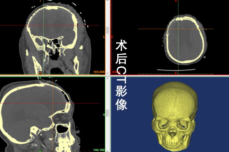 泰安市中心医院神经外科应用3d颅骨打印技术完美修复颅骨缺损 3d 颅骨 3d打印 新浪新闻