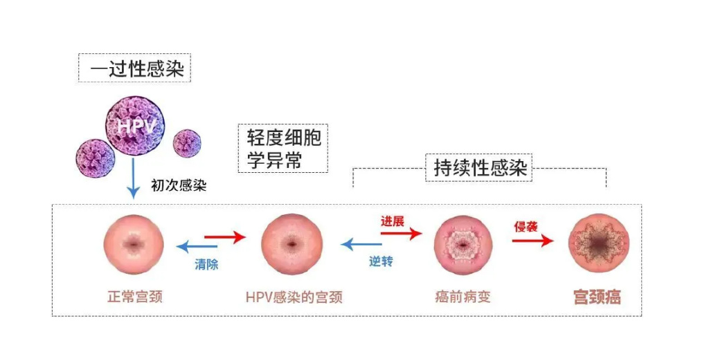 国际HPV知晓日：感染HPV怎么办？HPV能治愈吗？本文带你了解HPV知识