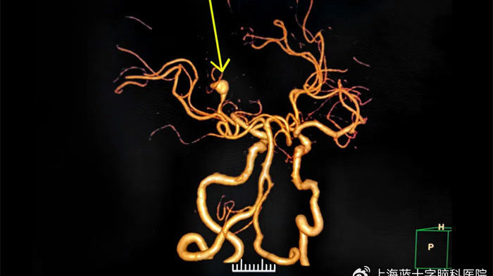 脑血管病做什么检查？专家解读：CTA、MRA、DSA|脑血管病|血管|脑血管_新浪新闻
