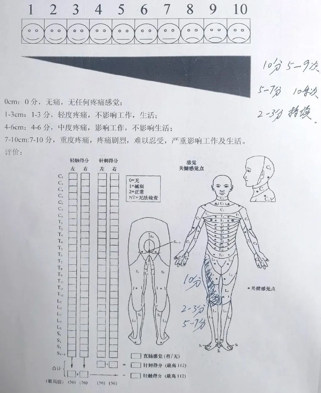 SCS脊髓电刺激疗法DTM™程控模式治疗25年右下肢顽固性疼痛