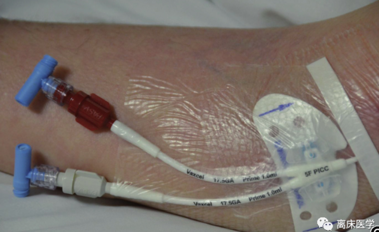 留置针、CVC、PICC、输液港有什么区别？5 种静脉通路大对比
