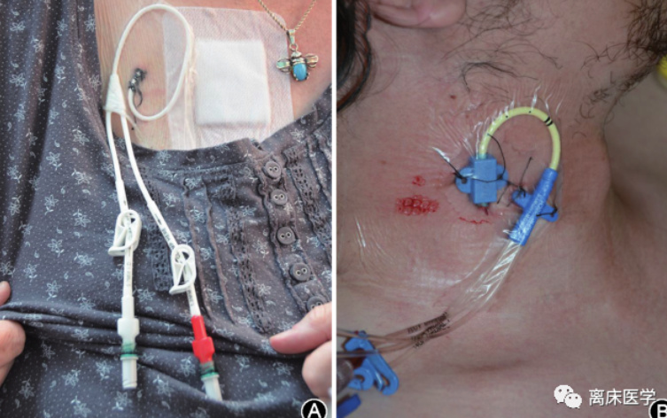 留置针、CVC、PICC、输液港有什么区别？5 种静脉通路大对比|静脉|导管|输液_新浪新闻