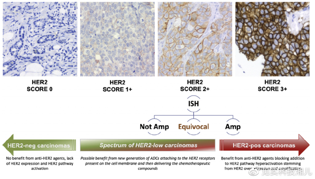 探寻在HER2低表达早期乳腺癌中的预后和临床意义|抗癌|乳腺癌|阳性_新浪新闻