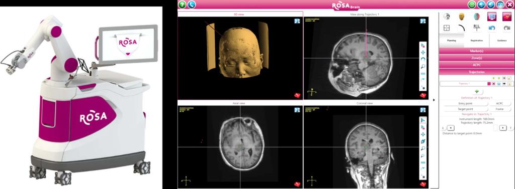 山东首例！齐鲁医院完成首台ROSA ONE机器人辅助神经外科丘脑病变活检微创手术