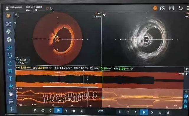 济医附院完成全省首例应用IVUS-OCT一体机指导心脏支架介入手术