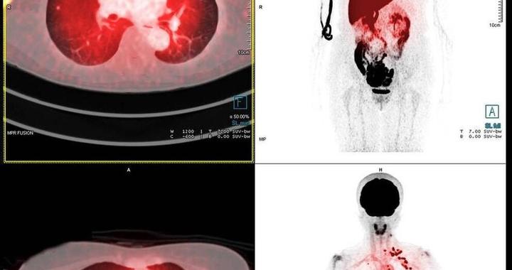 PET-CT与普通CT、增强CT有6大区别！肺结节有必要做吗？|CT|肿瘤_新浪新闻