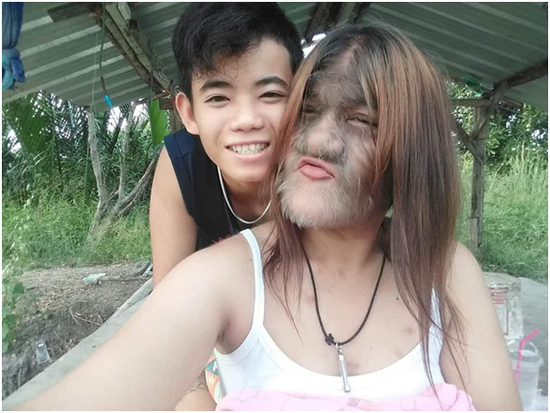 女孩满脸长毛被人嫌弃 如今模样大变_手机新浪网