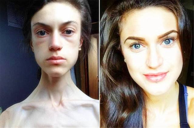 15岁女孩因情伤减肥瘦成皮包骨，仍然不敢吃饭！