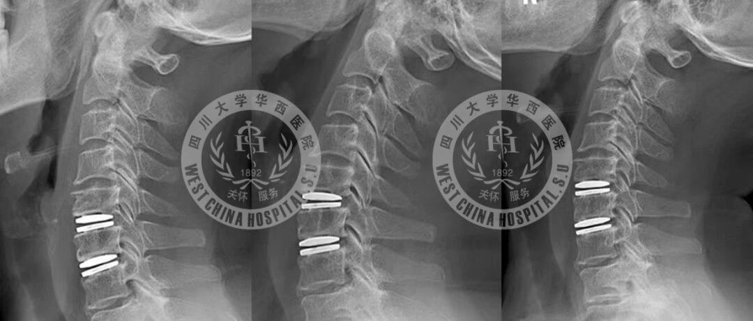 益者三友 | 病例研析：四川大学华西医院老年双节段Baguera-C人工颈椎间盘置换术（cTDR）|假体|颈椎间盘|颈椎_新浪新闻