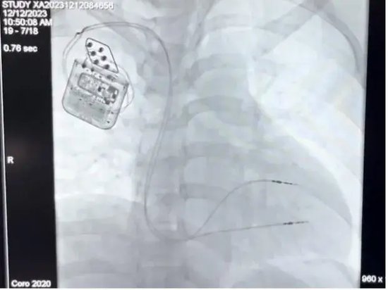 省内首例！海南省人民医院成功完成心脏收缩力调节器（CCM）植入手术_手机新浪网