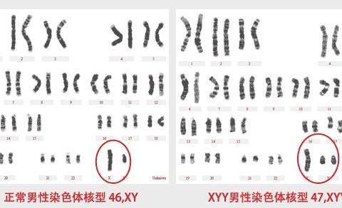 你知道染色体为XYY的人是什么样的吗？|染色体|综合征|患者_新浪新闻