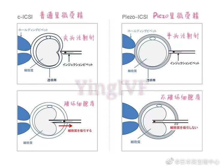 44岁姐姐，AMH0.46，采卵4颗，采用Piezo-ICSI超音振动显微受精