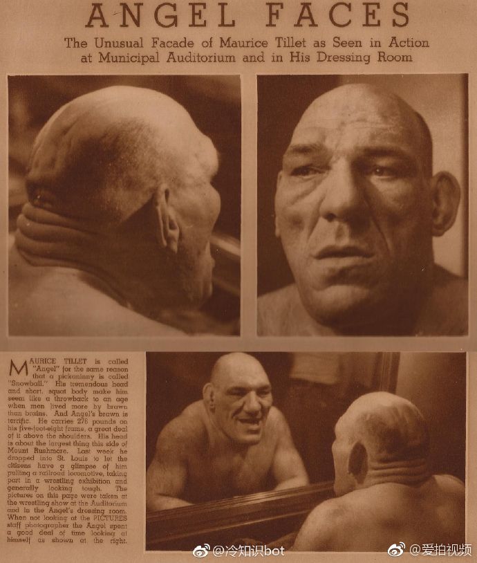 Maurice Tillet，一名罹患肢端肥大症的摔跤手。 他于1954年去世