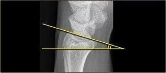 人体内一块被淘汰已久的骨头重现了，它到底有什么作用？