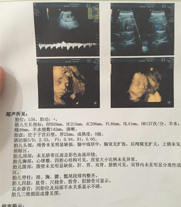 产前知男女, B超单看男女方法一览|孕囊|B超单|男宝宝_新浪新闻