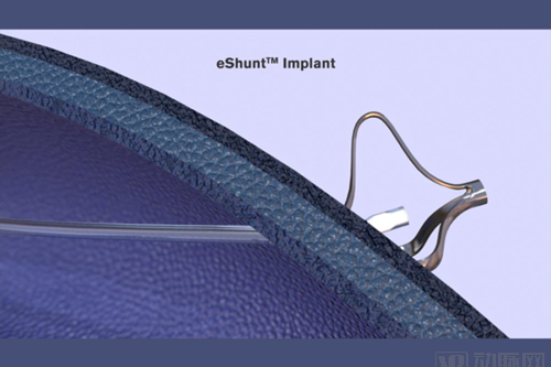 脑积水治疗设备的突破创新，帮助CereVasc斩获4390万美元A轮融资|分流术|脑积水|首席执行官_新浪新闻