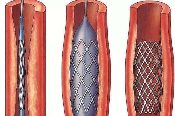 支架后再次出现狭窄，还能再次植入支架吗？|支架|血管|药物_新浪新闻