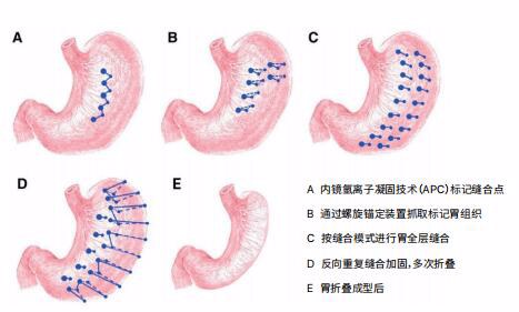 吴良平：推动中国内镜下减重外科领域从0到1|医疗|外科|代谢_新浪新闻