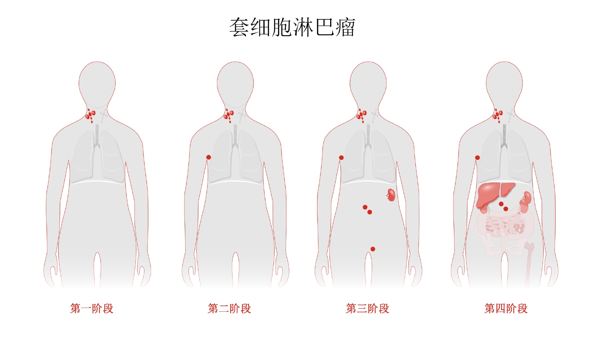套细胞淋巴瘤BTK抑制剂耐药患者新希望！新药Jaypirca在美获批