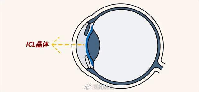 郑州眼科专家王新解答：ICL晶体植入术后注意事项