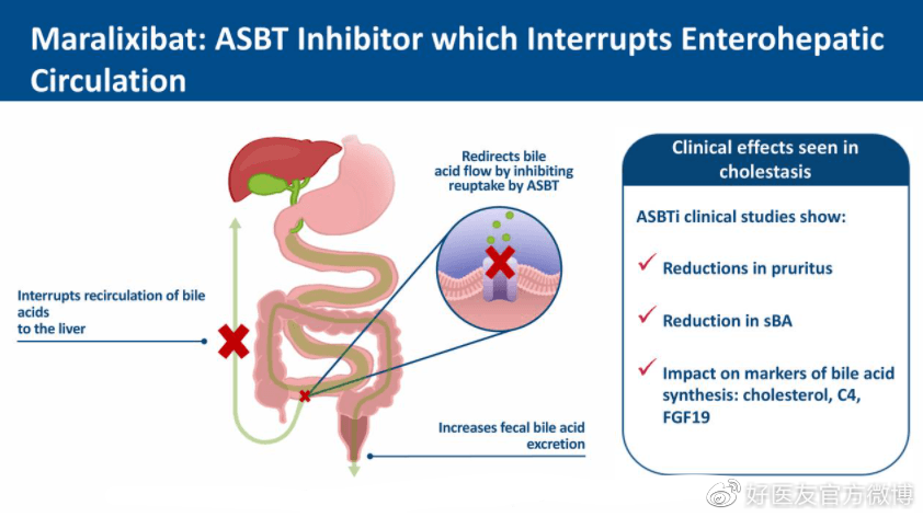 拯救“小黄人”！创新药Maralixibat有望改善严重瘙痒，降低胆汁水平|黄疸_新浪新闻