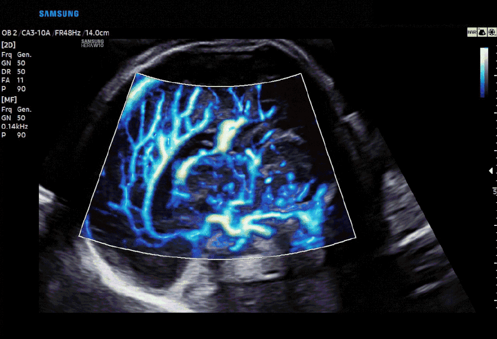 三星医疗新技术，洞悉胎儿“脑世界”|三星医疗|超声|胎儿_新浪新闻