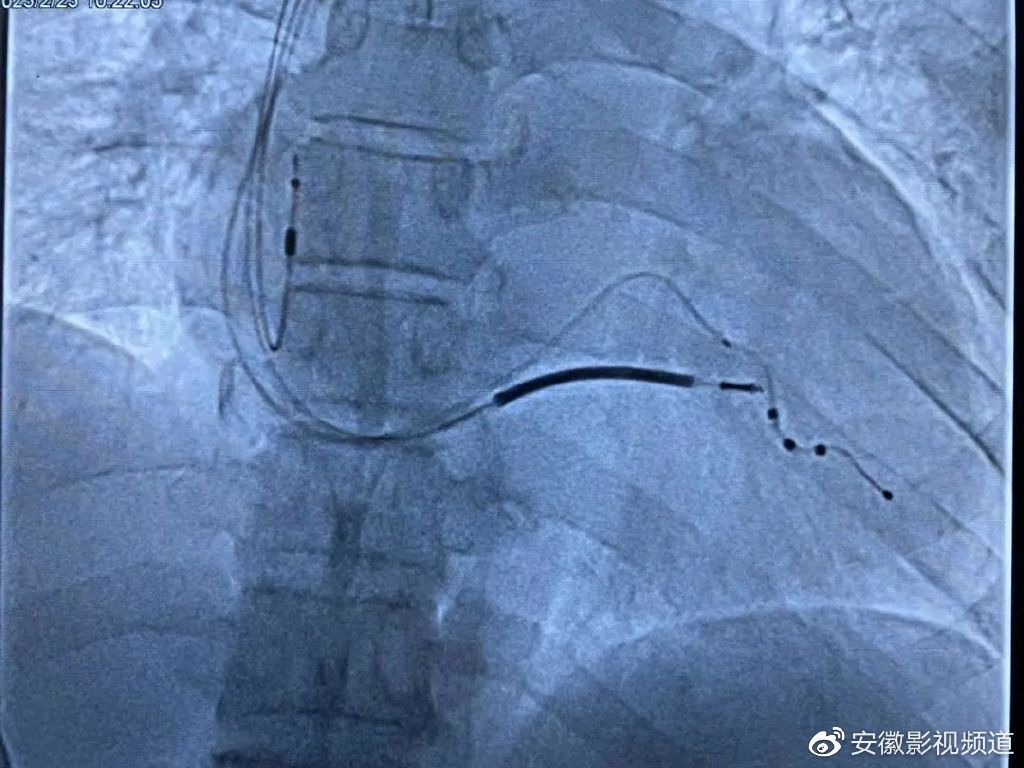 静安医院 | 心内科成功完成首例CRT-D（心脏再同步复律除颤器）植入术
