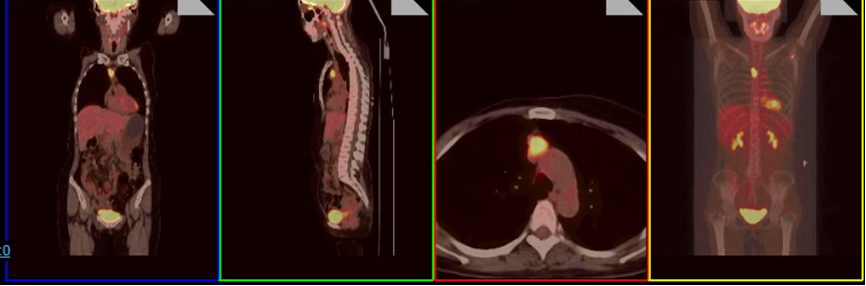 以曲妥珠单抗为基础治疗，为HER2阳性乳腺癌患者带来长期生存获益__财经头条