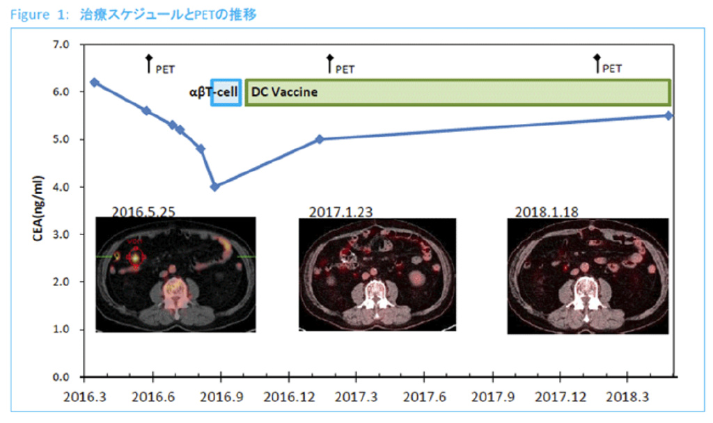 日本免疫细胞疗法之复发结直肠癌__财经头条