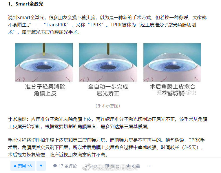 Smart全激光近视矫正手术，不是新技术，只是把老技术换了一个名字