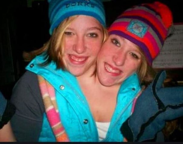 美国出现罕见“双头人”，姐妹俩共用一个身体，却爱上不同的男人