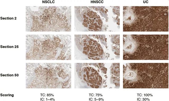 一文读懂PD-L1 检测之SP263的前世今生—抗癌管家|抗癌|检测|皮癌_新浪新闻