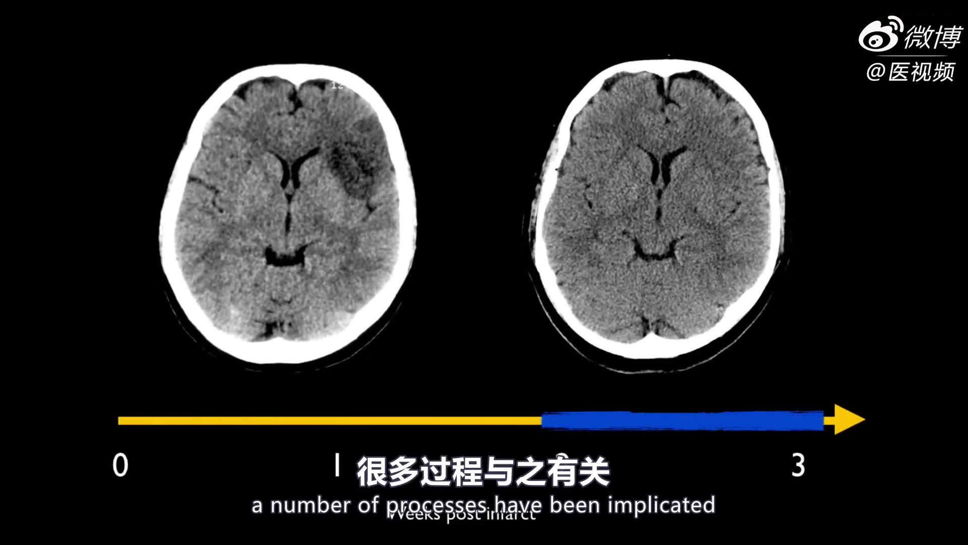 医学双语课程：放射科病例系列——CT表现中的模糊效应（Fogging phenomenon on CT）_新浪新闻