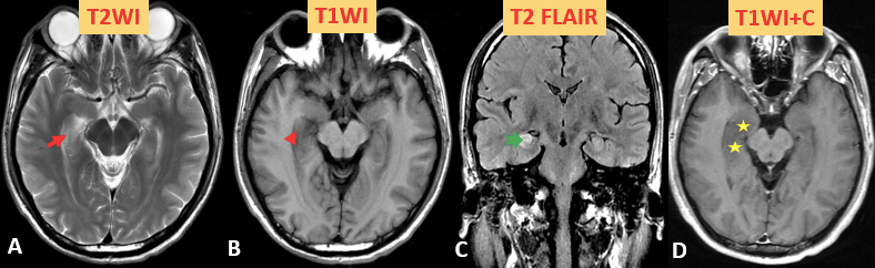 头颅 MRI 不会看？DWI、ADC、T1WI......这篇文章讲清楚了！|信号|序列|成像_新浪新闻