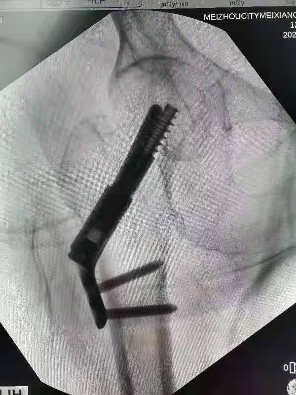 梅州完成首例股骨颈骨折CCS复合加压螺钉内固定术|骨折_新浪新闻