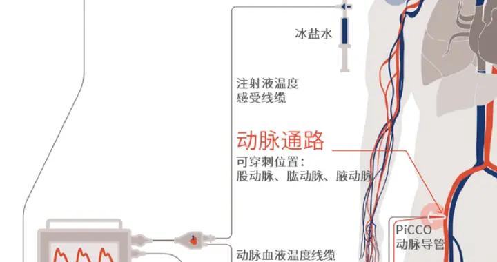 PiCCO技术工作原理及参数解读|血管_新浪新闻