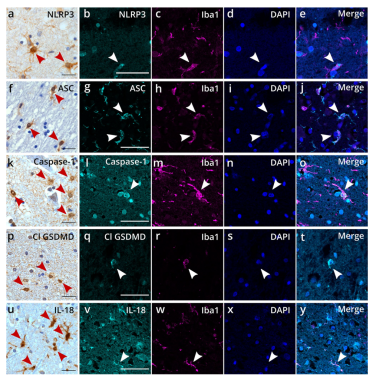 大脑白质小胶质细胞焦亡激活增加与ALS运动皮层神经元丢失有关|转基因|变性|胶质_新浪新闻