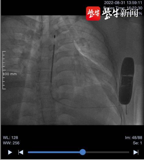 心脏性猝死防护利器——常州首例独立植入全皮下心律转复除颤器（S-ICD）成功__财经头条