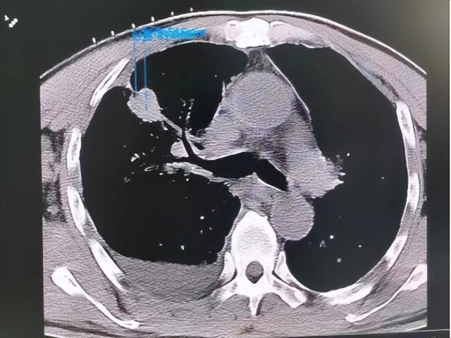 一“针”窥因果！CT引导下经皮肺穿刺活检精准识别，找出“真凶”__财经头条