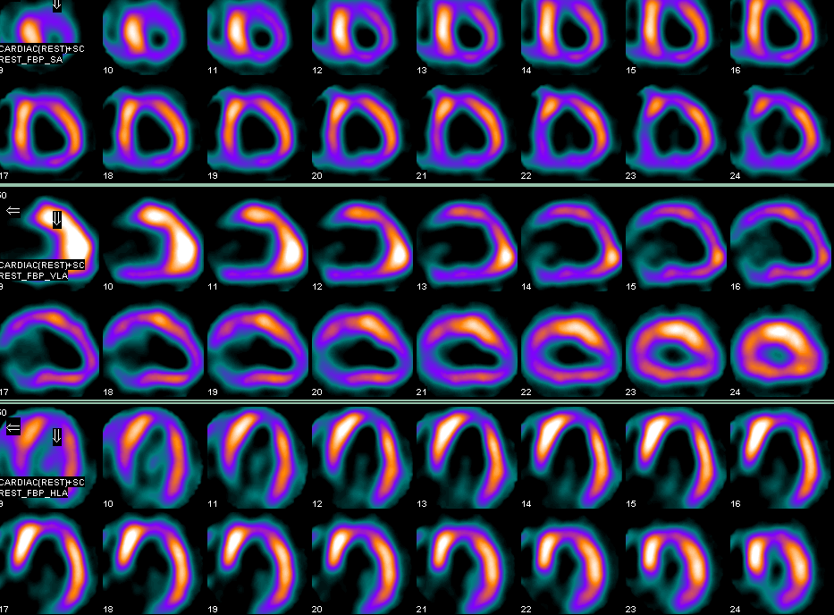 【共盼春来】更安全、更精准~核医学科心肌血流灌注显像“心”检测~|心肌炎|核医学科|冠心病_新浪新闻