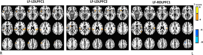 Frontiers in Neurosci: 重复经颅磁刺激（rTMS）研究新进展
