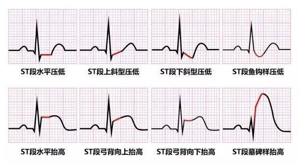 解答丨教你看懂，体检报告上的心电图术语→