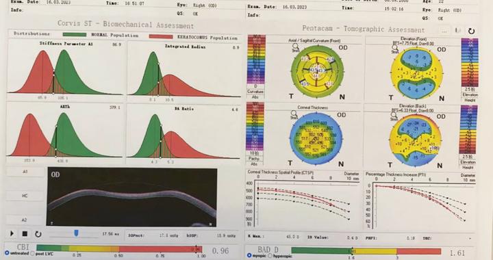 CorvisST和PentacamHR组成黄金CP！双利器让湘潭近视手术更安全|圆锥角膜|爱尔眼科|角膜_新浪新闻