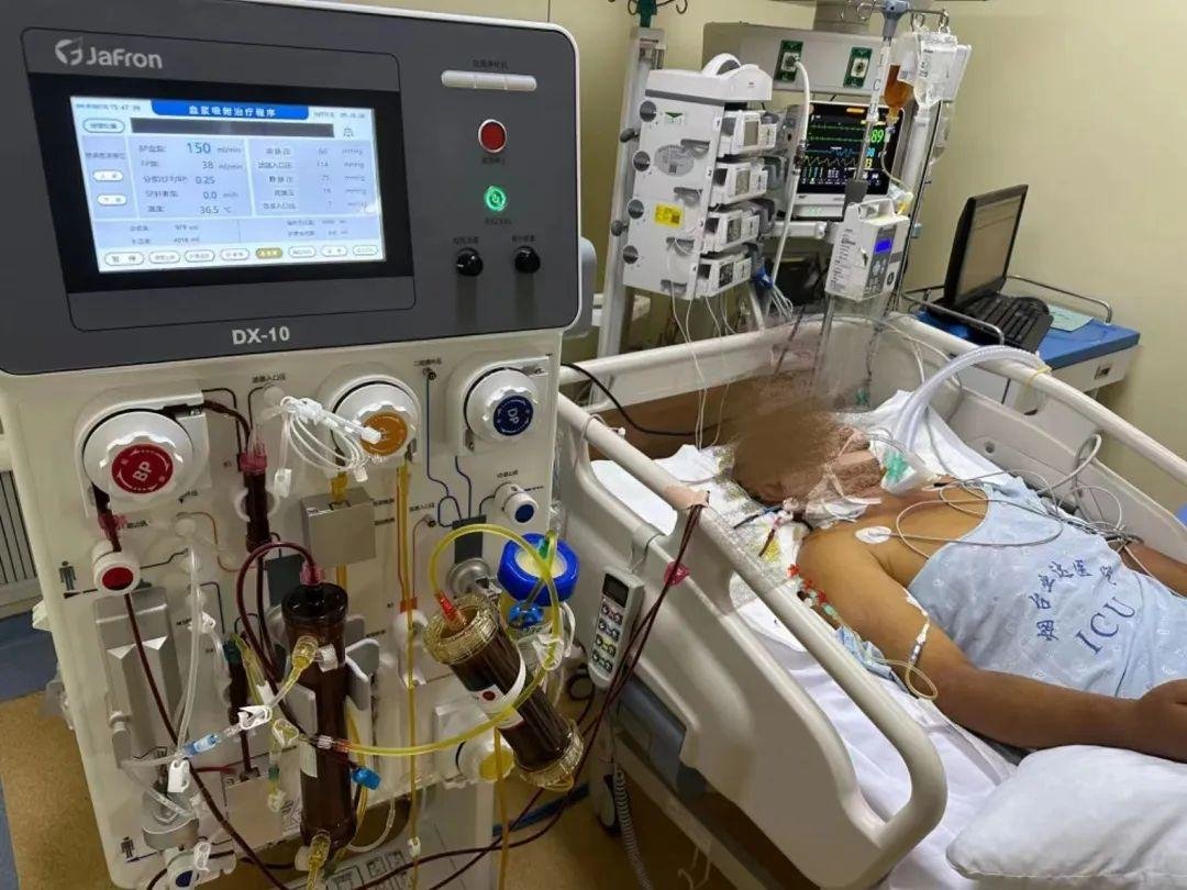 烟台业达医院开展首例DPMAS序贯血浆置换人工肝技术