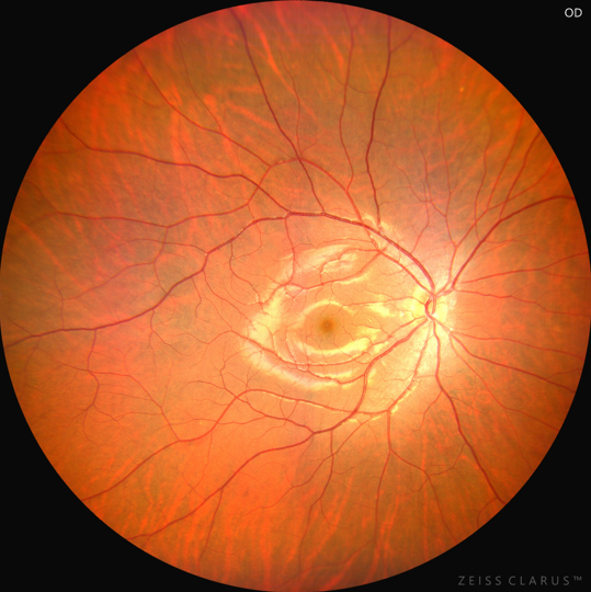 睛彩眼科引进的蔡司CLARUS 500超广角眼底相机真的很强大|医疗|眼底|睛彩|蔡司|眼科_新浪新闻